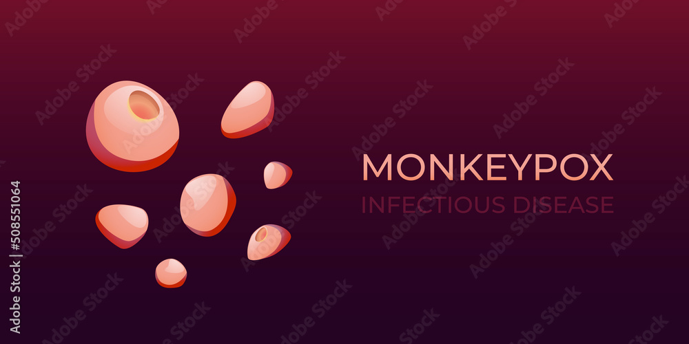 Monkeypox 2022 outbreak. Infectious virus disease. The evolution of ...