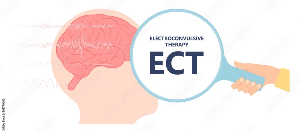 Plakat ECT treat the MDD and Major TMS electric current brain mental ...