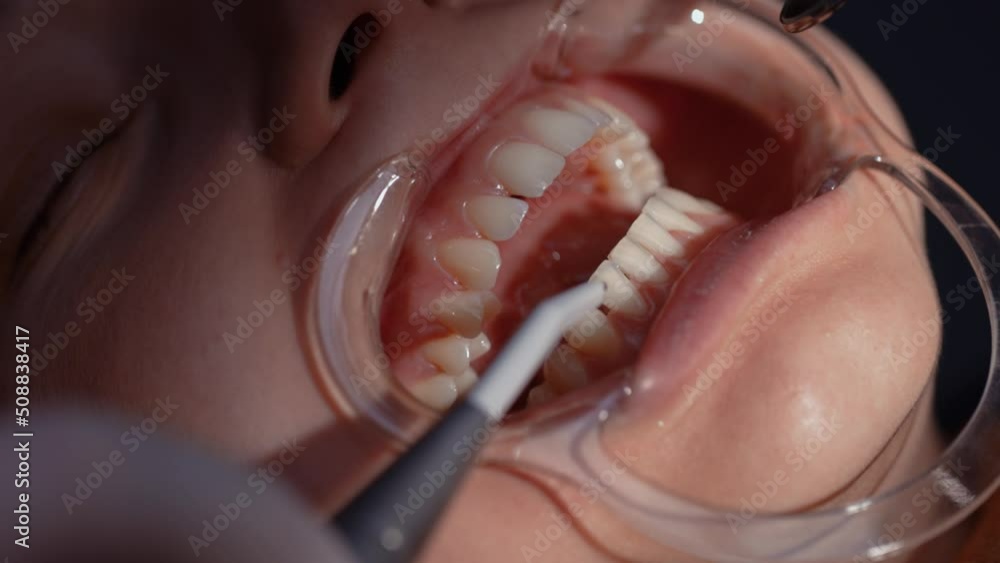 Examination of the teeth. Close-up of patient open mouth during oral ...