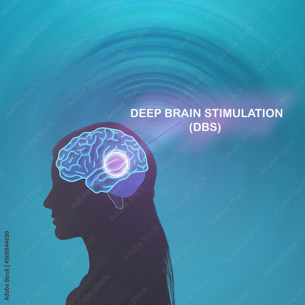 Deep brain stimulation. Human head silhouette with glowing brain. DBS ...