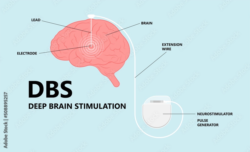 Deep brain stimulation or DBS treat Parkinson's disease PD and TMS ... Deep brain stimulation or DBS treat Parkinson's disease PD and TMS ...