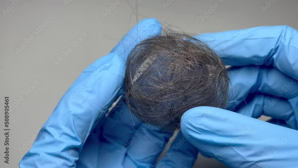 Vidéo Stock Gloved doctors's hands hold a Ball of hair. Hair loss ...