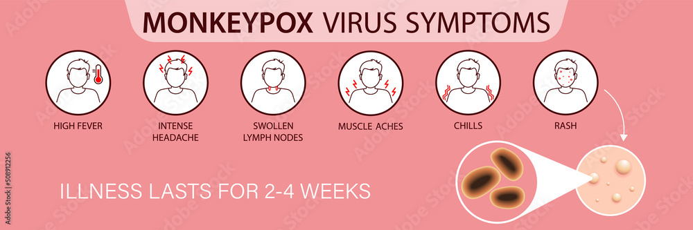 Symptoms of the monkey pox virus. Monkey pox is spreading. This causes ...