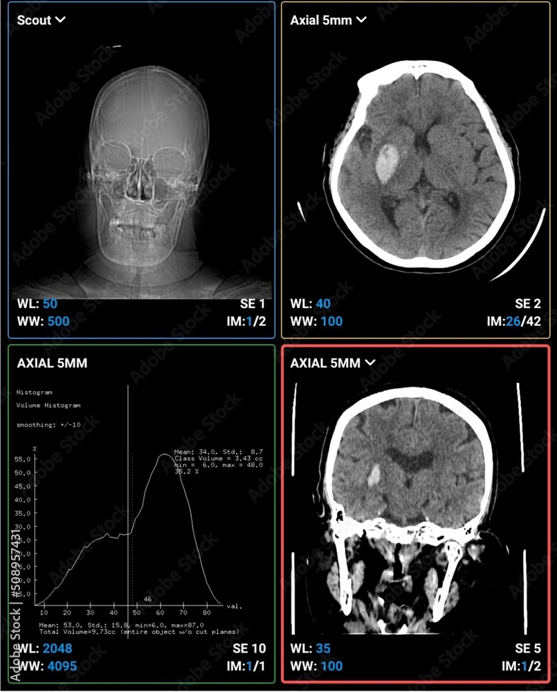 head ct scan of bleeding stroke on right basal ganglia Stock Photo ...