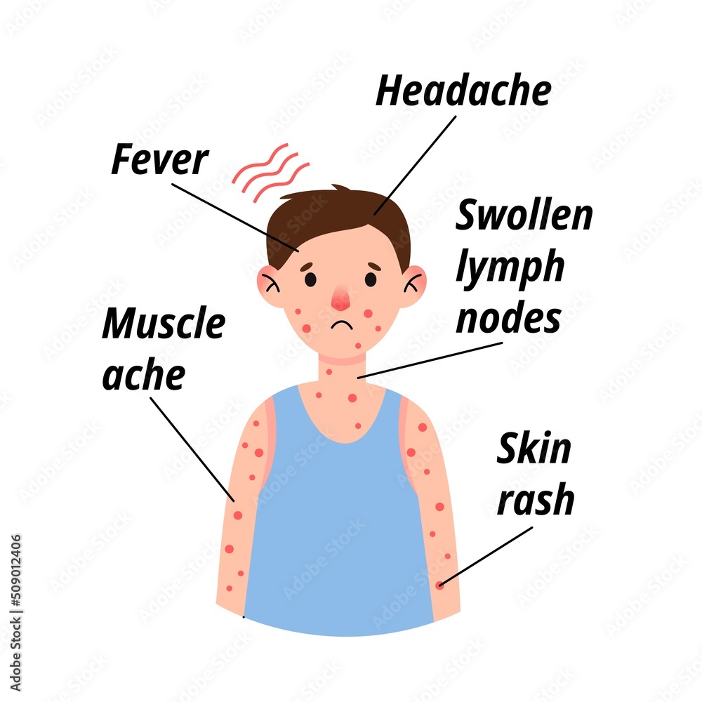 Monkeypox virus symptom infographic on child patient with fever ...