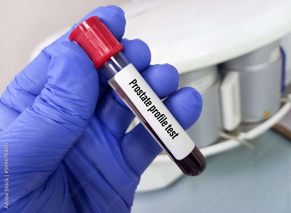 Test tube with sample for Prostate Profile test, to diagnosis of ...