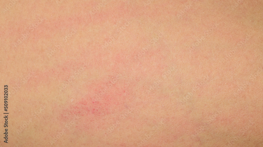 red rash on human skin Stock Photo | Adobe Stock