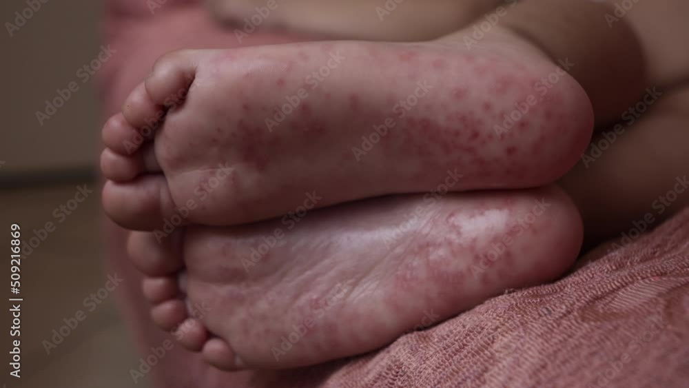 Strong rash on child 's feet Stock Video | Adobe Stock