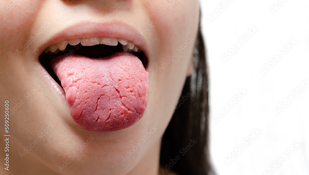 Tongue of a young Caucasian woman with benign migratory glossitis ...