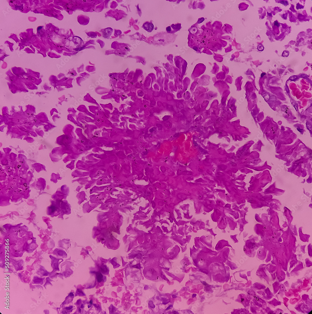 Poster Intra-cranial space occupying lesion(biopsy): Brain cancer ...