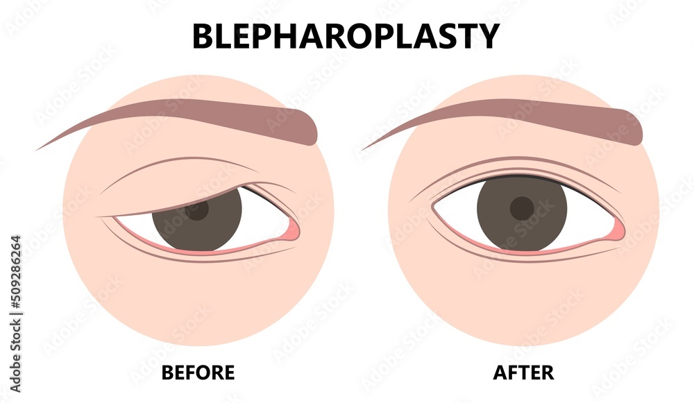 Before and after of drooping eyelid lift surgery or blepharoplasty ...