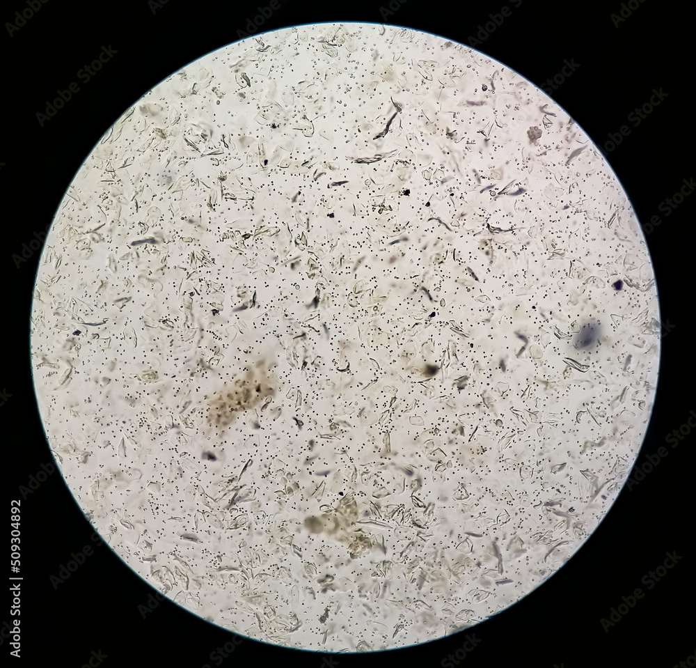 Microscopic urine examination showing Hyaline cast with plenty pus cell ...