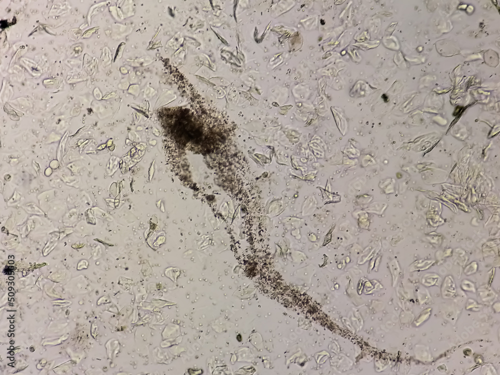 Microscopic urine examination showing Hyaline cast with plenty pus cell ...