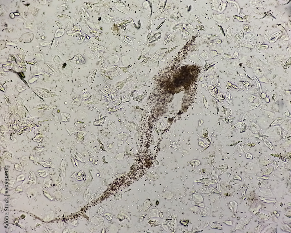 Microscopic urine examination showing Hyaline cast with plenty pus cell ...