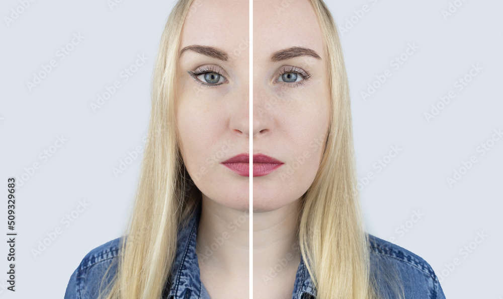 Fox eye lift. Before and after. On left is a girl with normal eyes, and ...