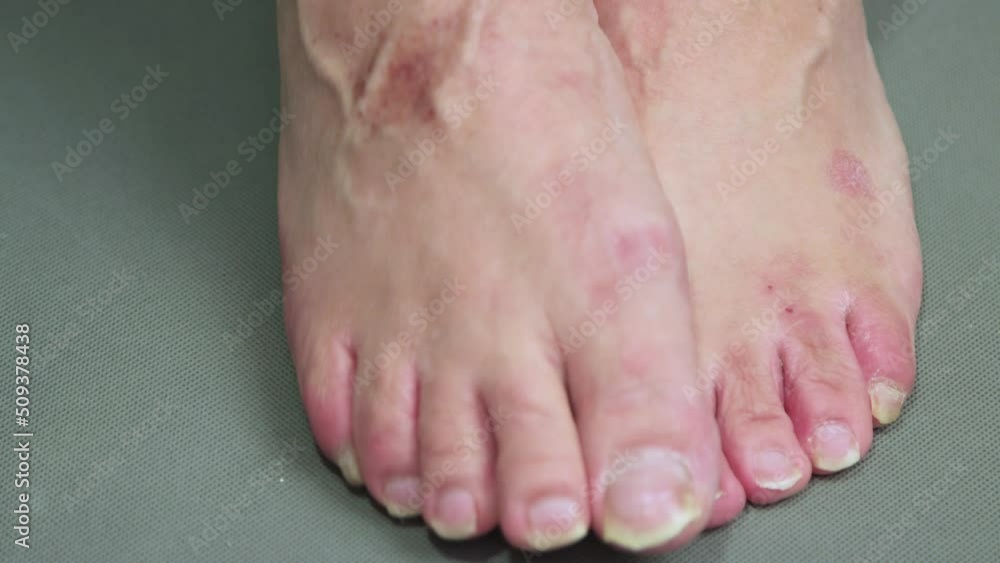 Men's legs scratch each other. Keratinization and thickening of the ...
