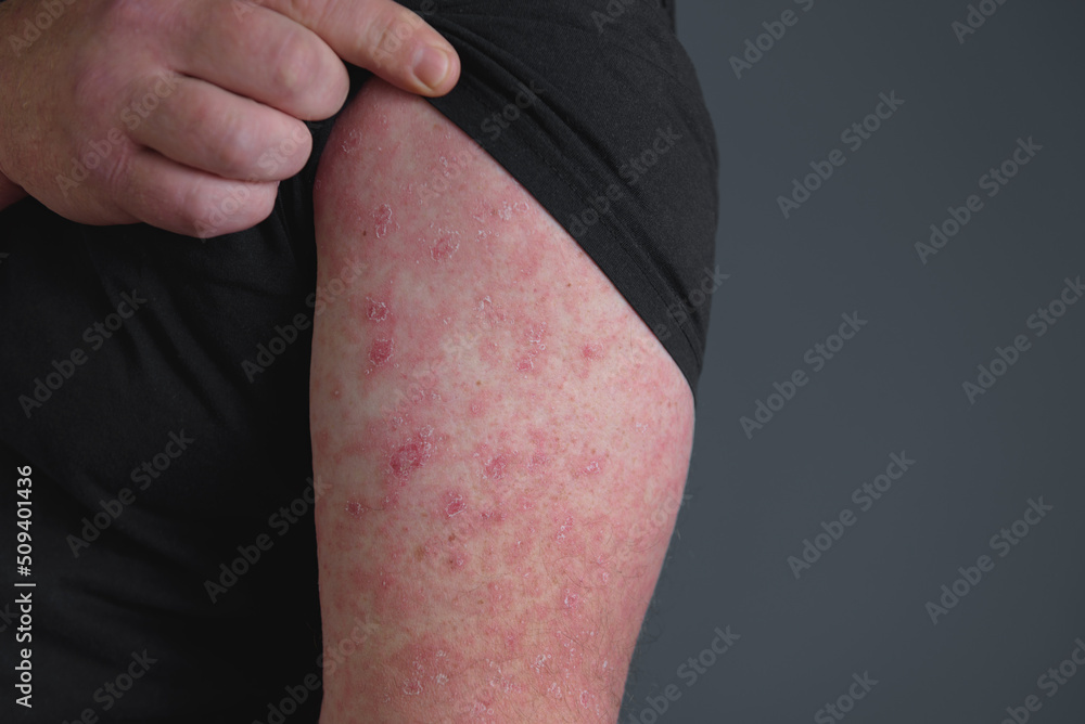 Red rash on forearm. Hand afflicted вermatophytosis on skin. Erysipelas ...
