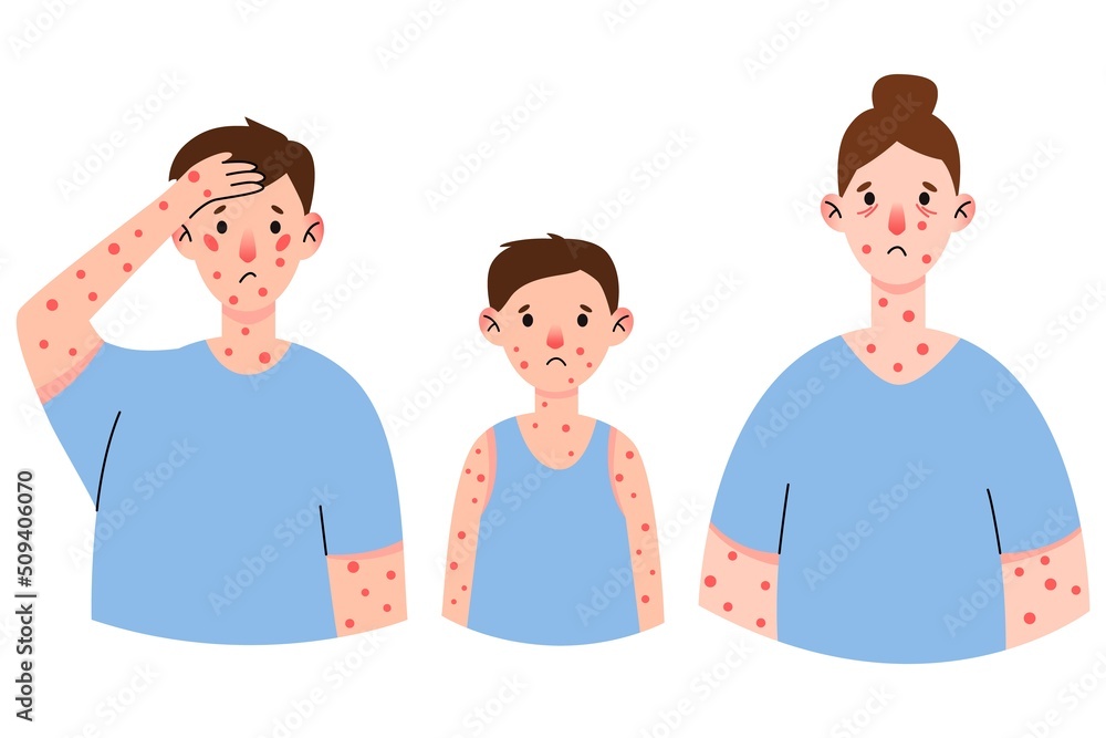 Set monkeypox virus symptom on patient with fever, headache, swollen ...