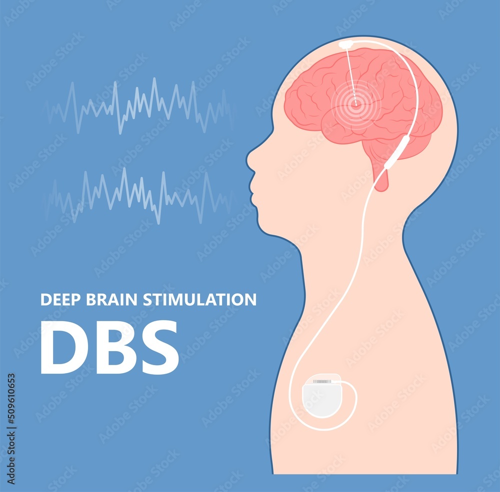 Deep brain stimulation or DBS treat Parkinson's disease PD and TMS ...