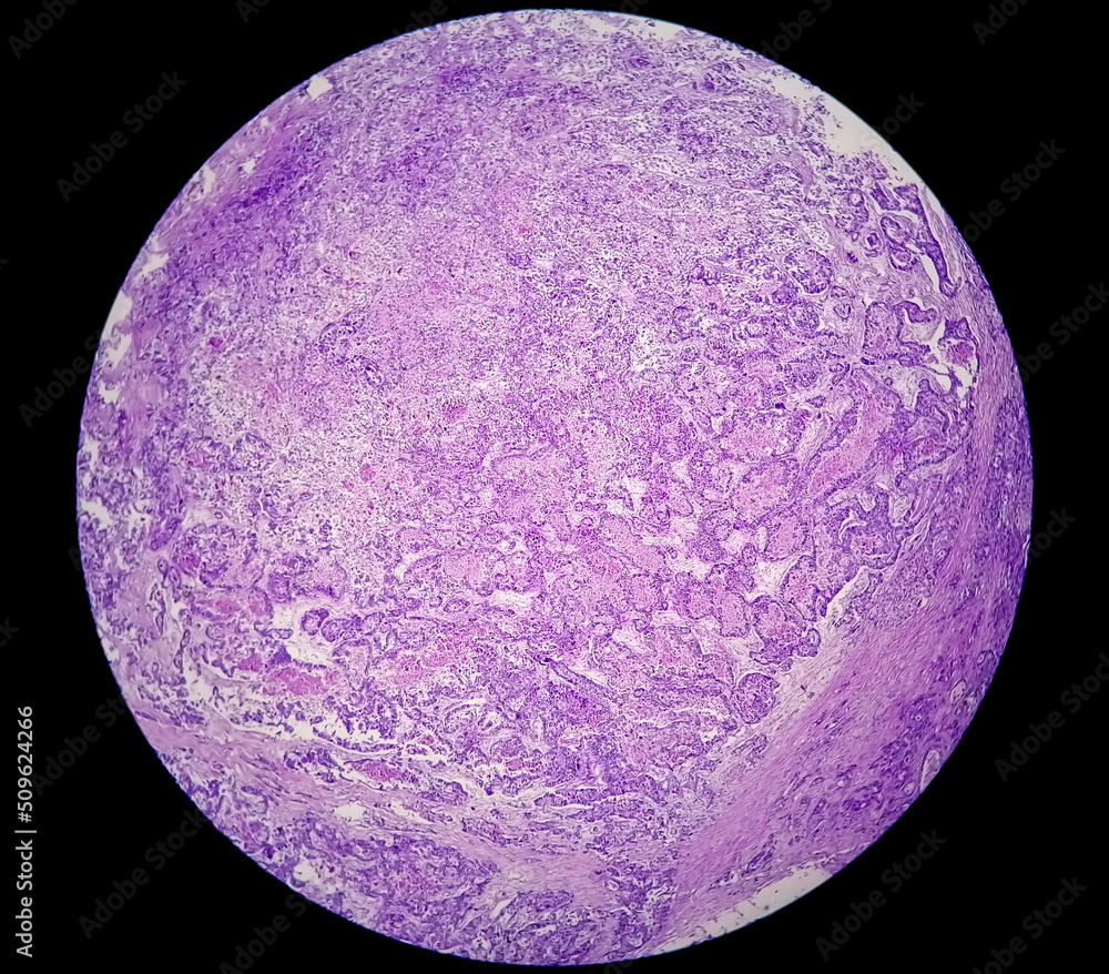 Stomach cancer: Adenocarcinoma of stomach, antrum cancer. High grade ...