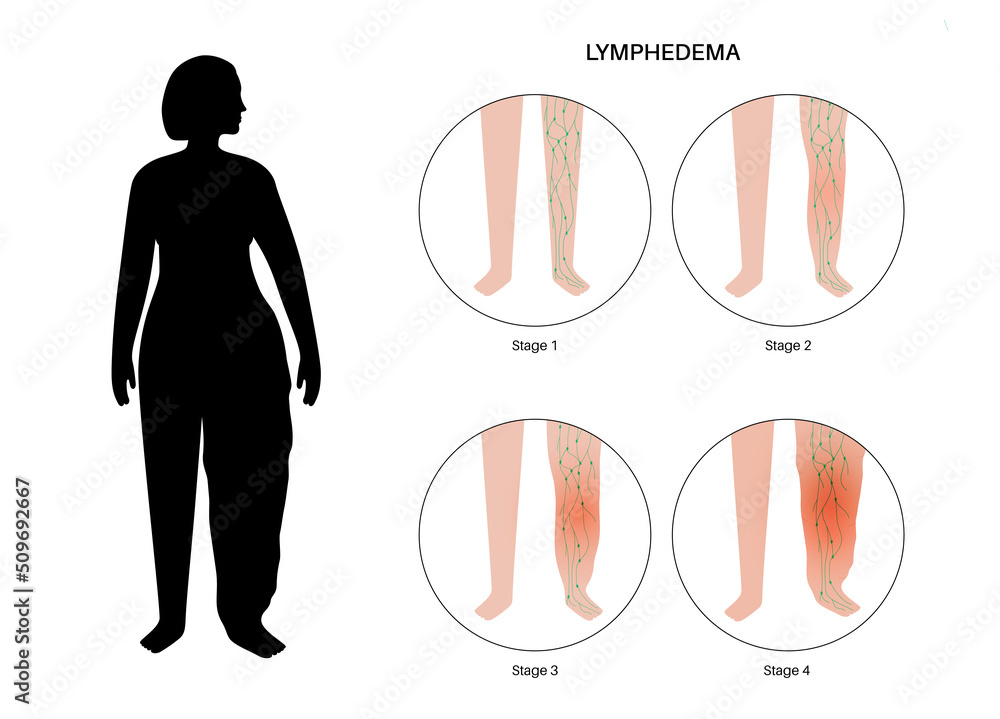 Stages of lymphedema Stock Vector | Adobe Stock