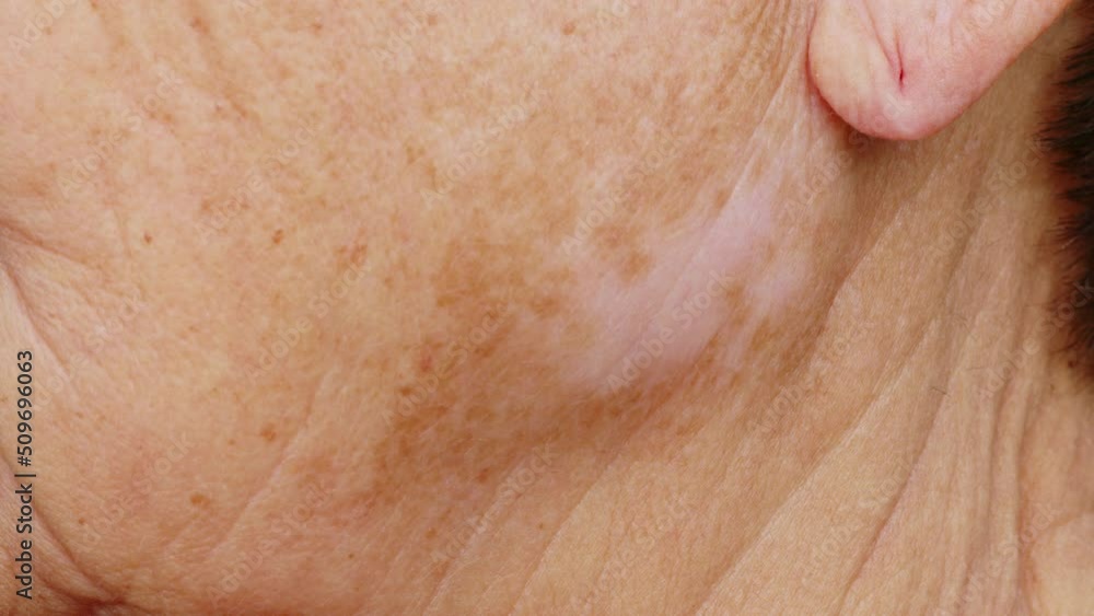 Spots on skin of elderly woman face. Pigmentation on female face. Close ...