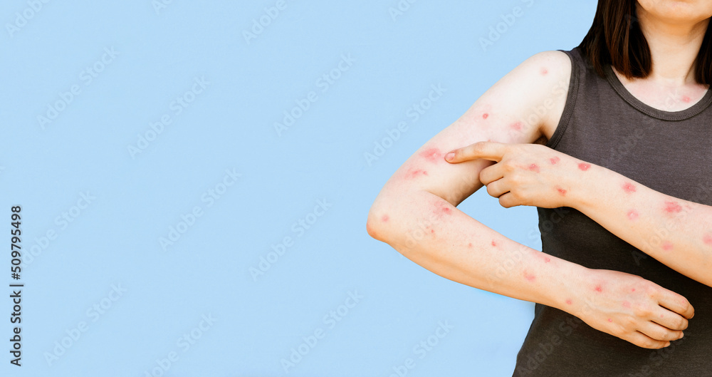 Foto de Monkeypox new disease dangerous over the world. Patient with ...