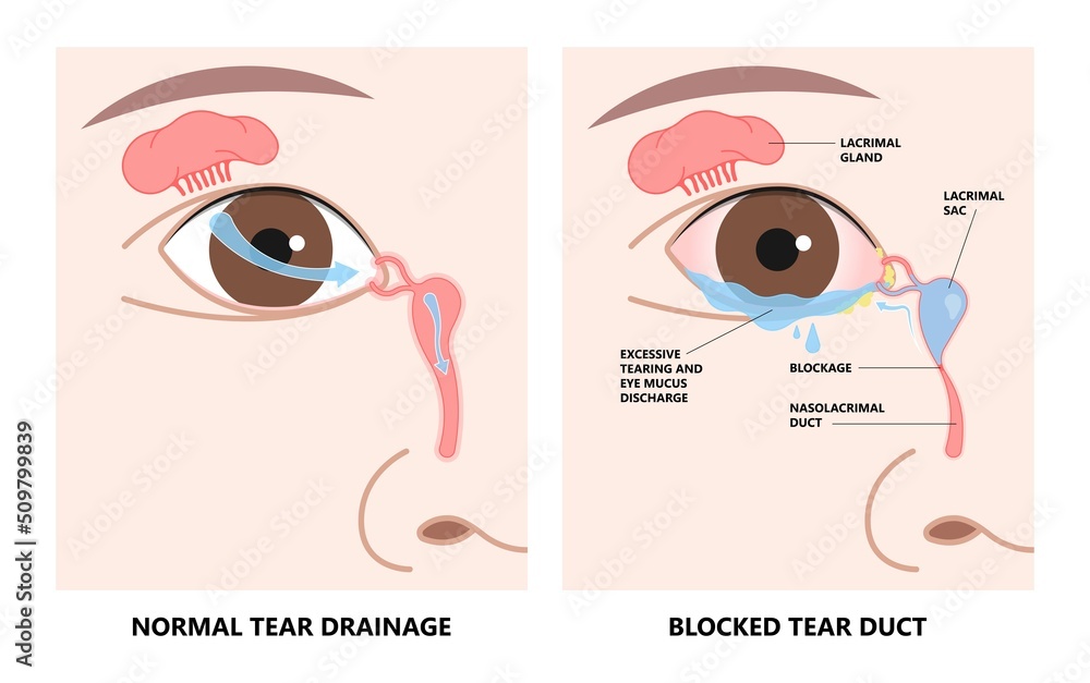 Fototapeta Blocked tear duct eye sinus toddler red dry swollen nasal ...