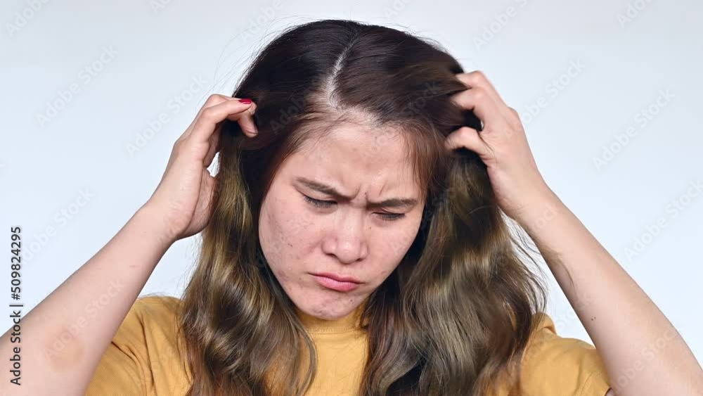 Asian woman scratching her scalp caused of itchy scalp. Dandruff and an ...