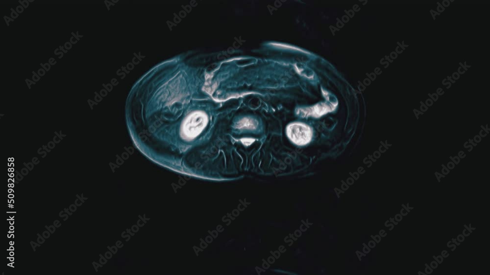 Voluminous color CT scan of the abdomen. Computed tomography of the ...