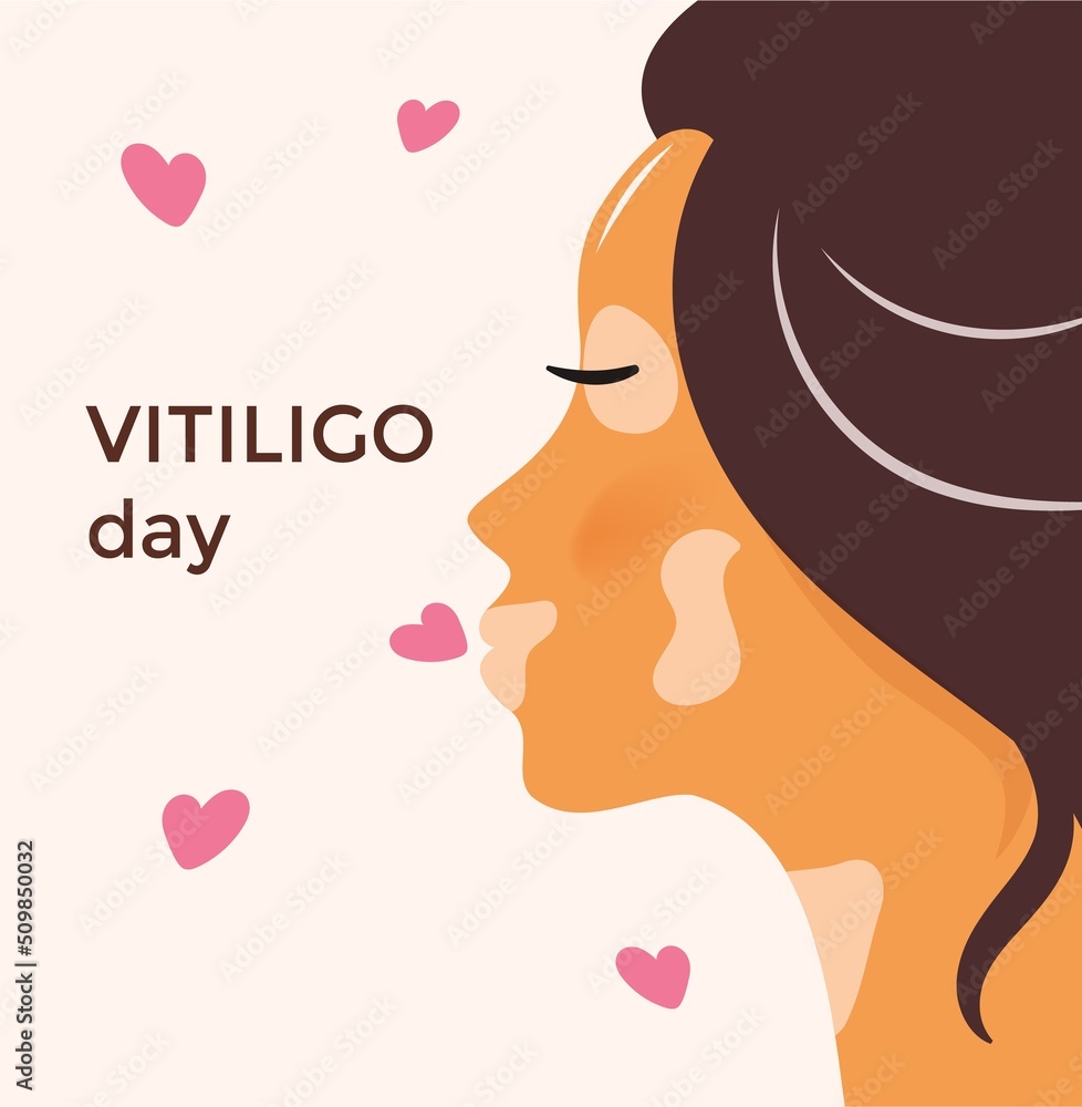 World vitiligo day June 25 square banner. Face cute woman with vitiligo ...