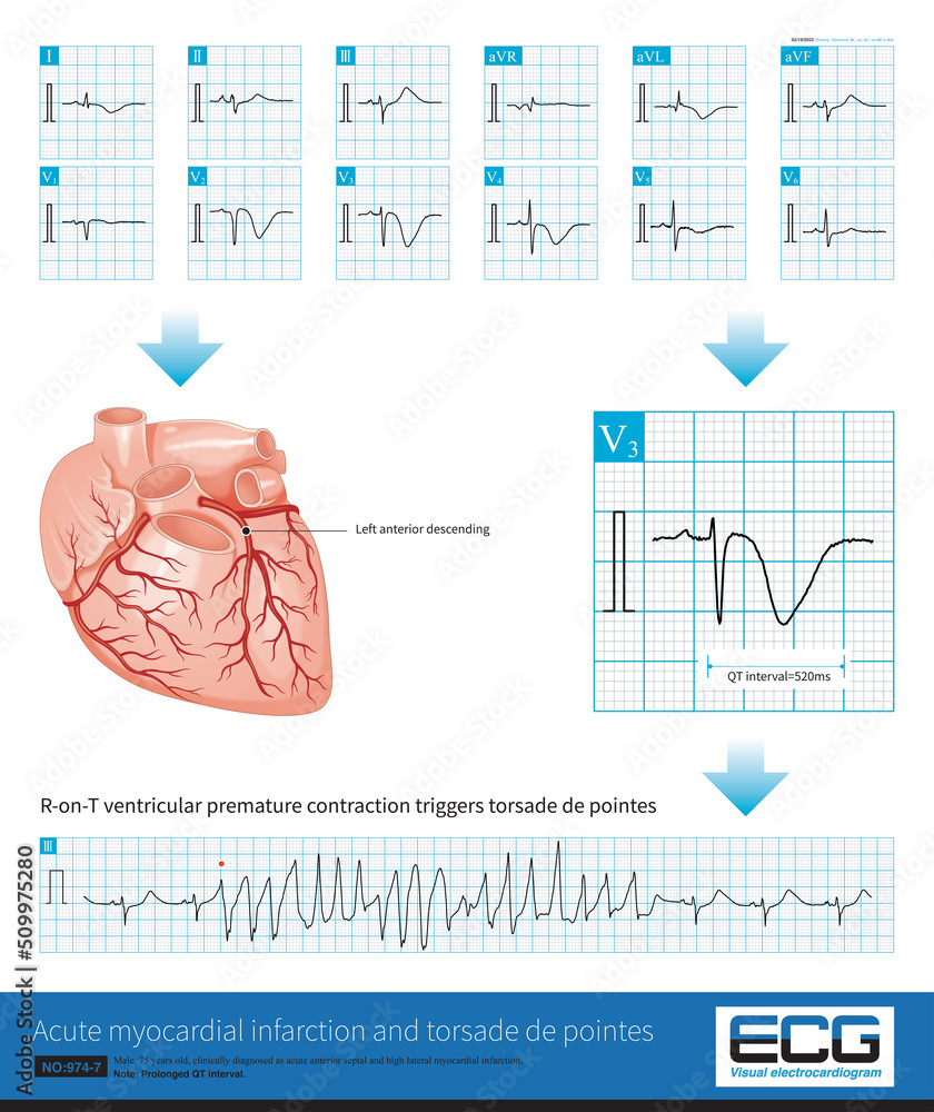 Male, 75 years old, clinically diagnosed as acute anterior septal and ...