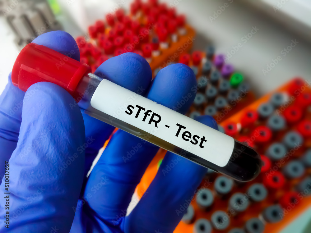 Soluble transferrin receptor (sTfR) test. this test help to detect and ...