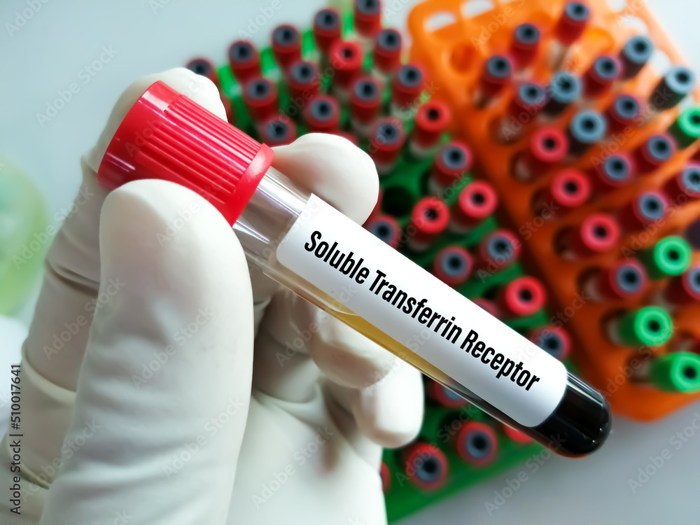Soluble transferrin receptor (sTfR) test. this test help to detect and ...