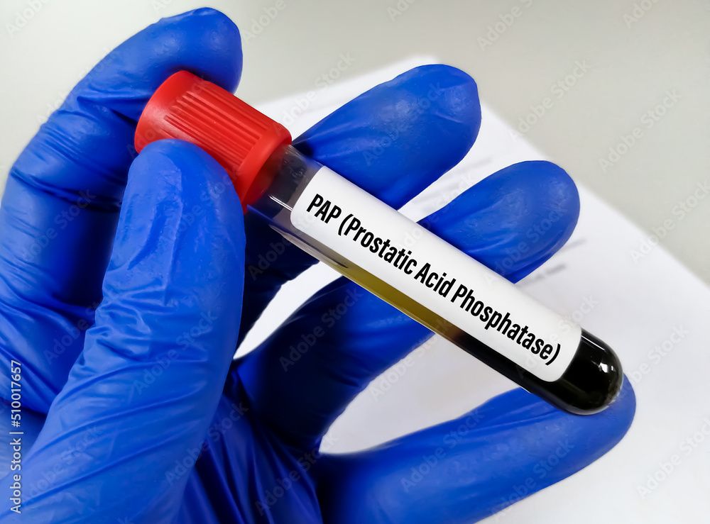 Blood sample for prostatic acid phosphatase (PAP) test in laboratory ...
