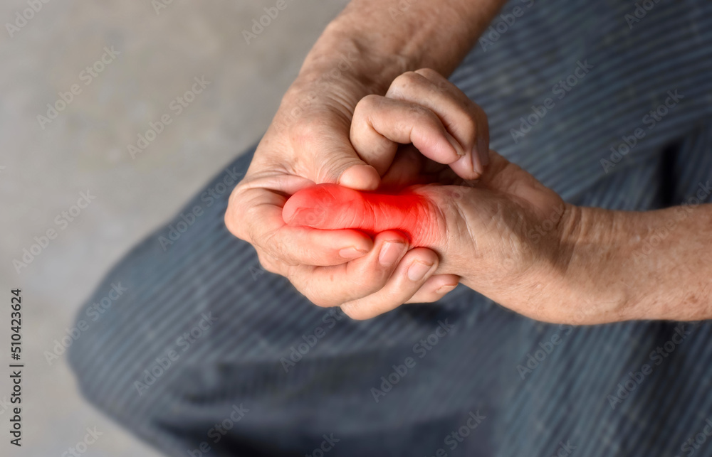 Inflammation of Asian man thumb and hand. Concept of cellulitis and ...