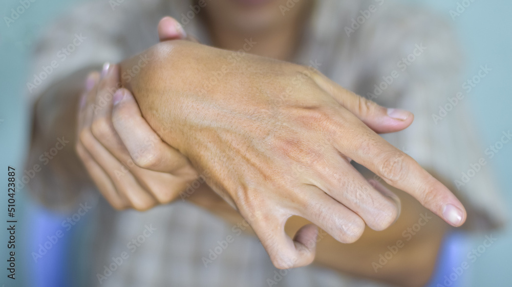 Ulnar claw hand of Asian young man. also known as 'spinster's claw ...