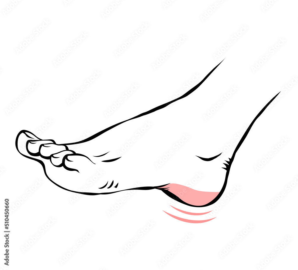Line sketch female leg with problematic pain. Sore heel. Orthopedic ...
