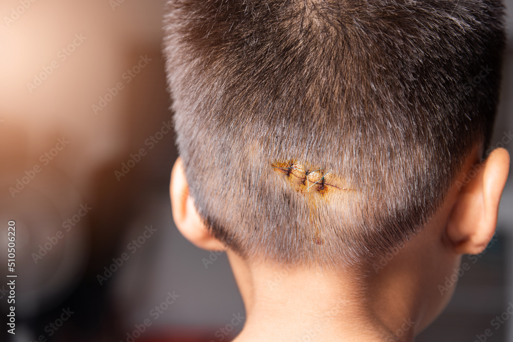 The lacerated sutured wound of kid back head which suture by nylon ...