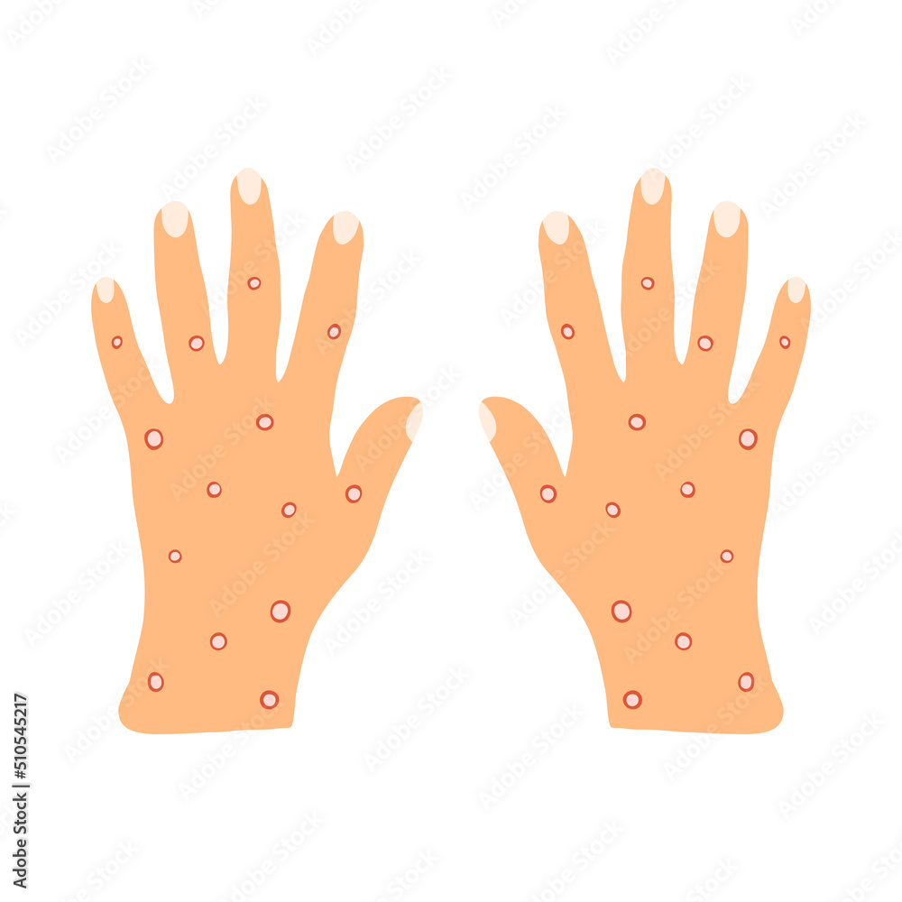 Monkeypox symptoms, hand skin rashes, blisters and purulent formations ...