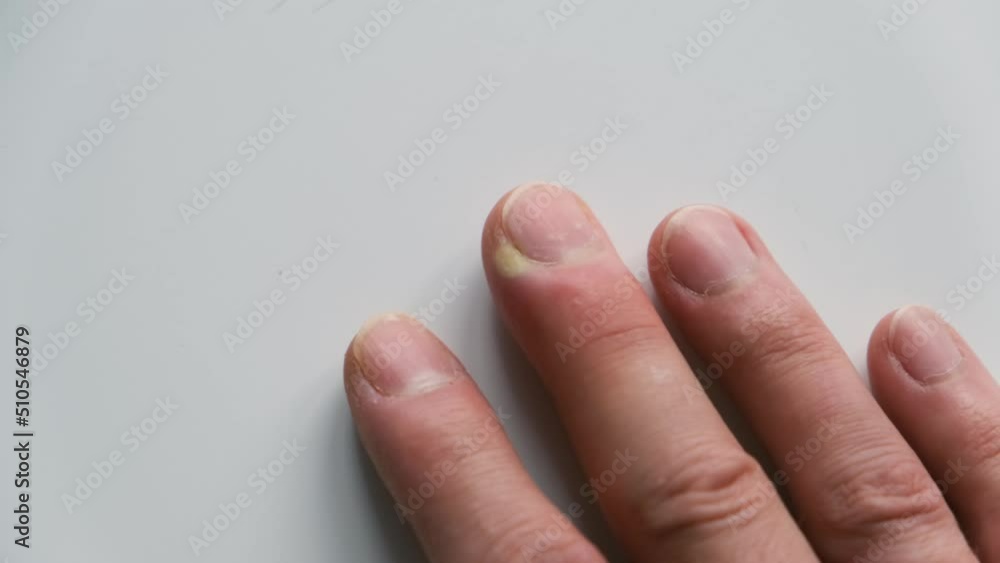 Swollen finger on a white background. The distal phalanx of the finger ...