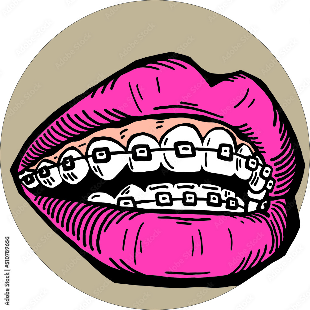 Braces on the teeth. Medical dentist checkup in dental clinic. Tooth ...