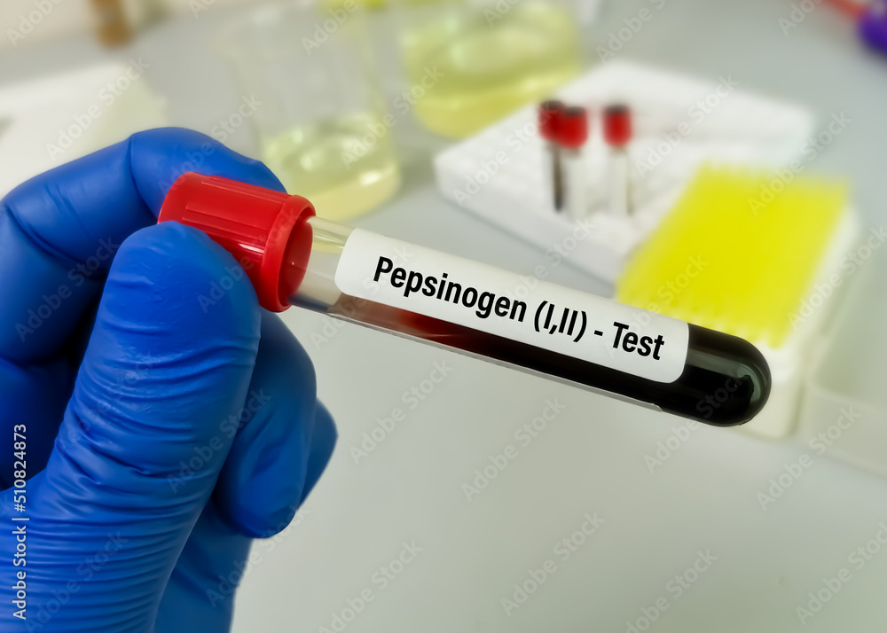 Scientist hold blood sample for Pepsinogen (I,II) test, diagnosis for ...