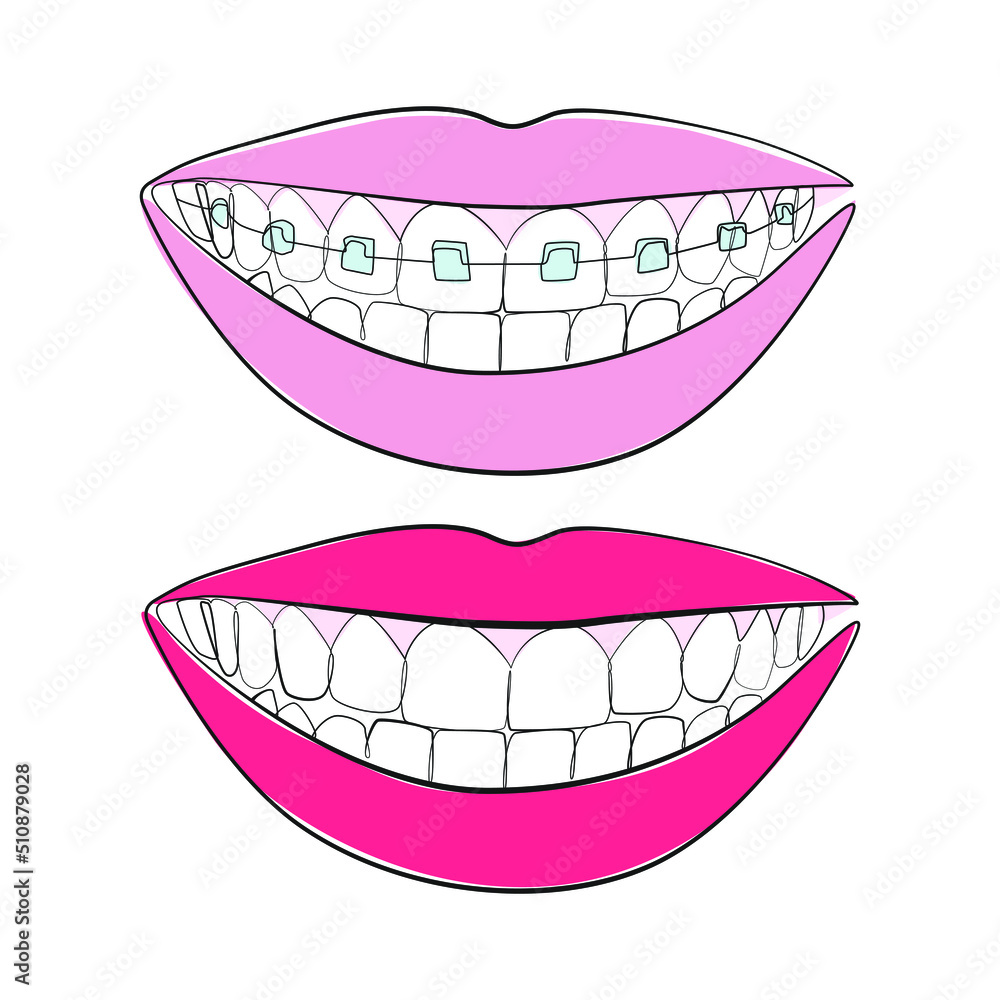 Teeth with braces one line drawing on white isolated background. Female ...