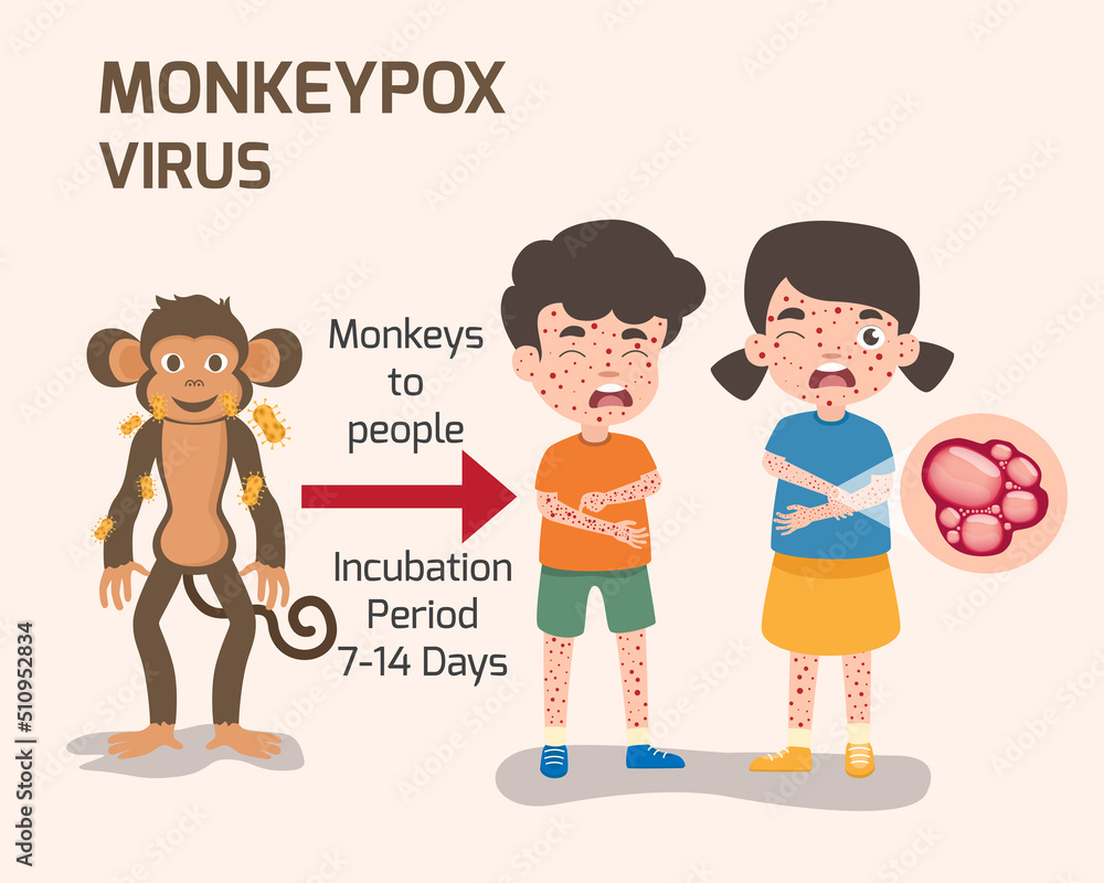Monkeypox virus elements, Human body with rash. Symptoms of the disease ...