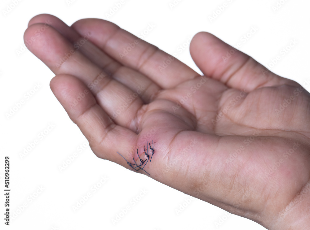 Hand injured by a cut. Surgical suture made by a surgeon on white ...