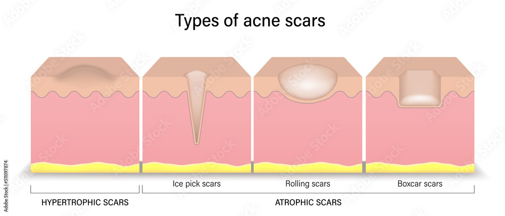 Types of acne scars. Facial skin problems. Hypertrophic scars and ...