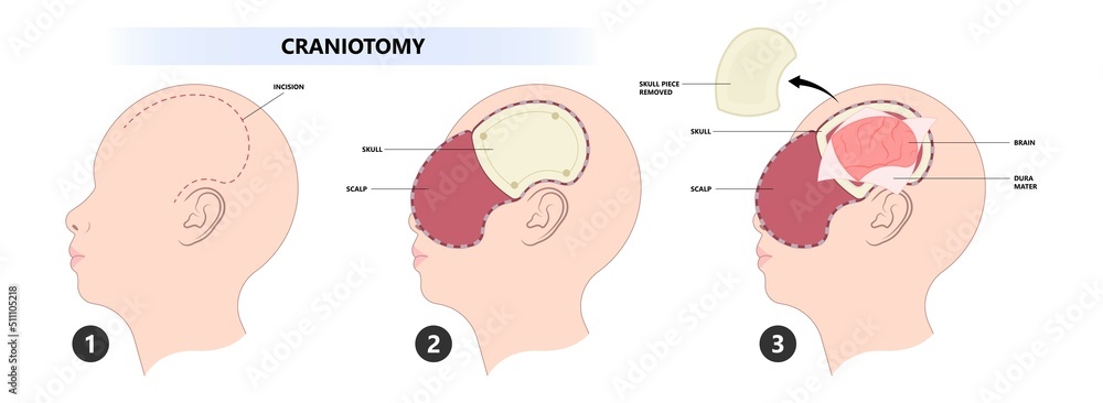 surgical to repair the skull bone with the metal mesh the procedure in ...