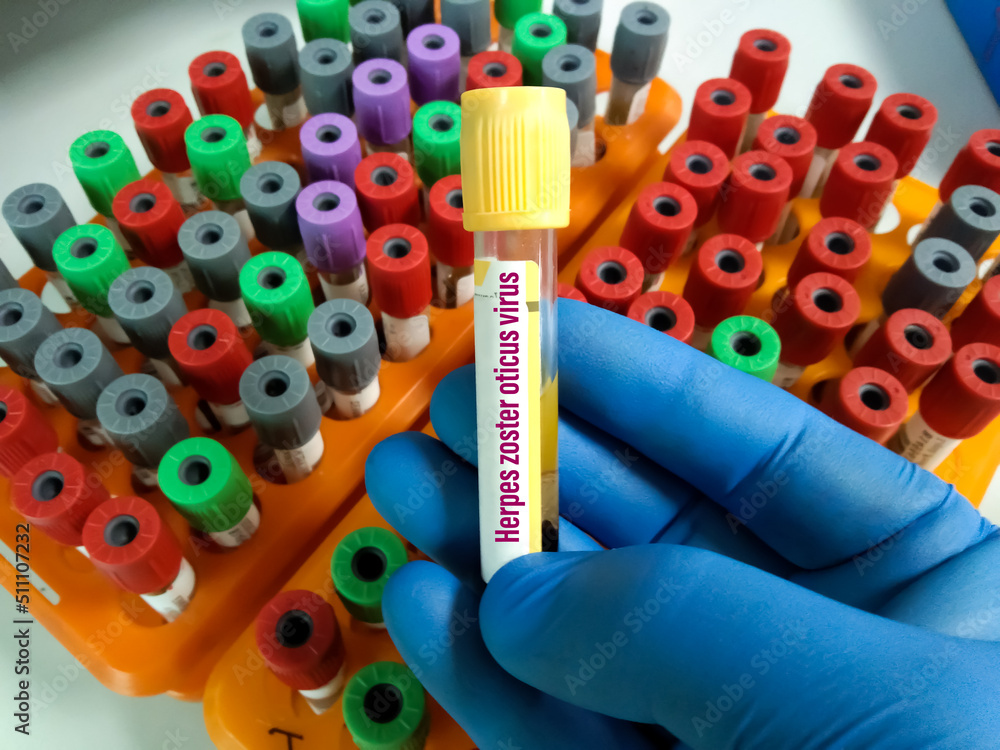 Ramsay Hunt syndrome blood sample test at medical laboratory. Which is ...