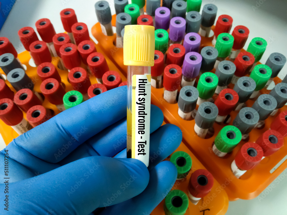 Ramsay Hunt syndrome blood sample test at medical laboratory. Which is ...